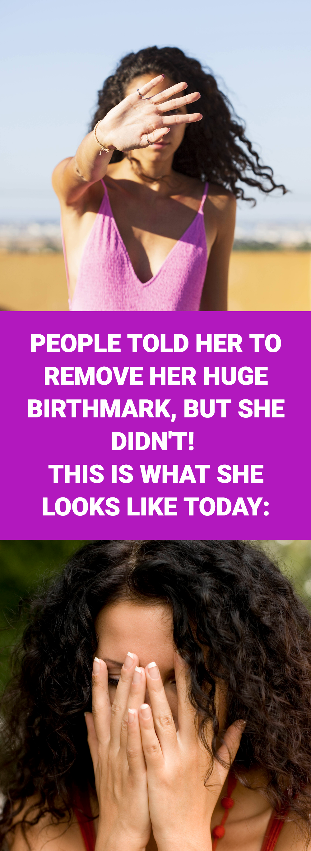 People Told Her To Remove Her Birthmark, Today She's A Model